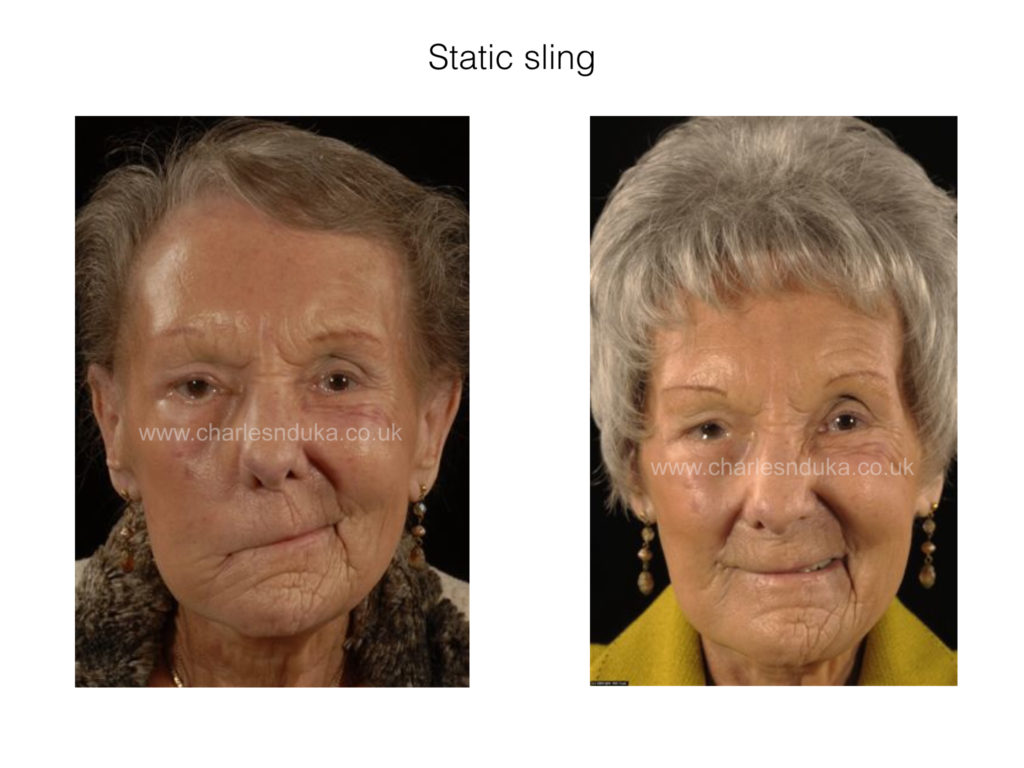Facial Paralysis | Charles Nduka - Plastic Surgery