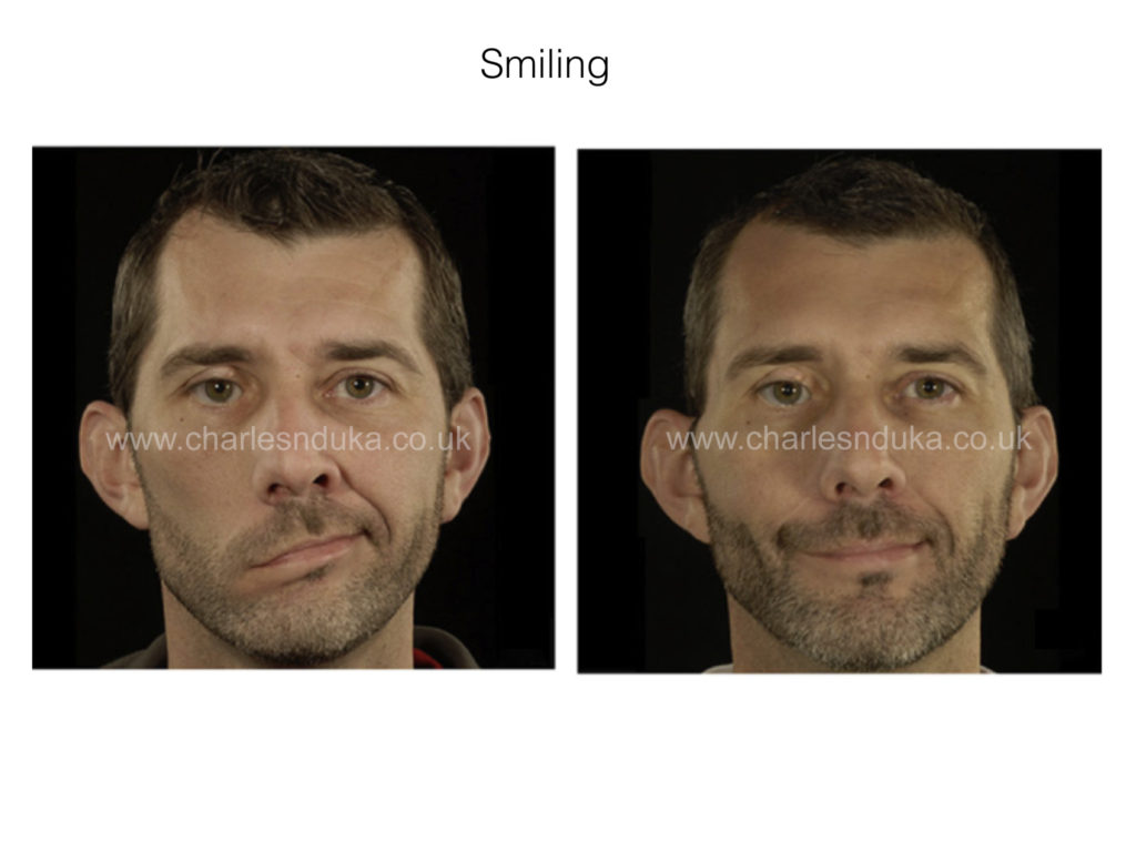 Facial Paralysis | Charles Nduka - Plastic Surgery